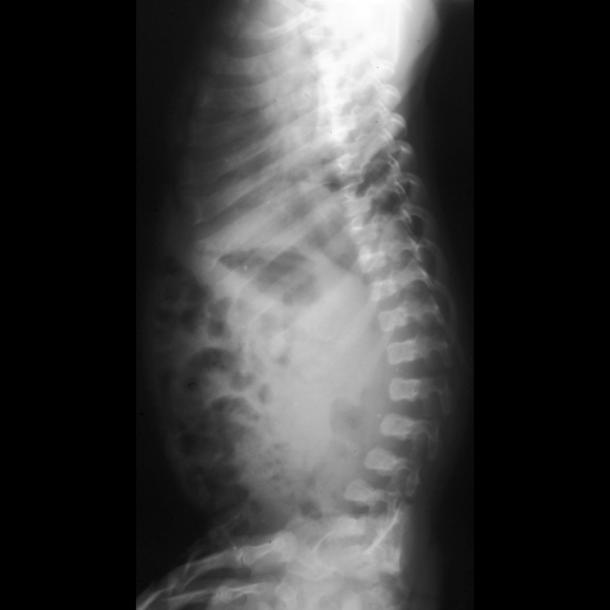 Preschooler with short stature | Pediatric Radiology Case | Pediatric ...