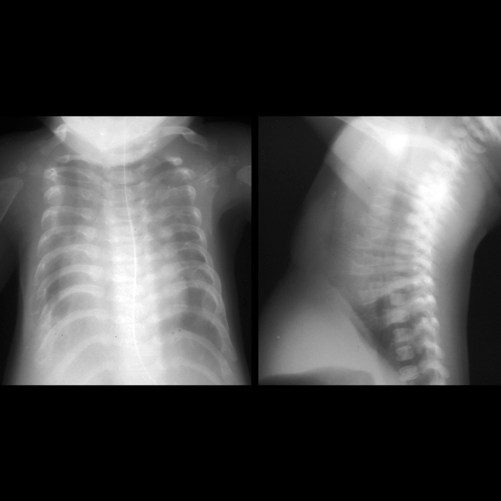 Asphyxiating Thoracic Dystrophy | Pediatric Radiology Reference Article ...