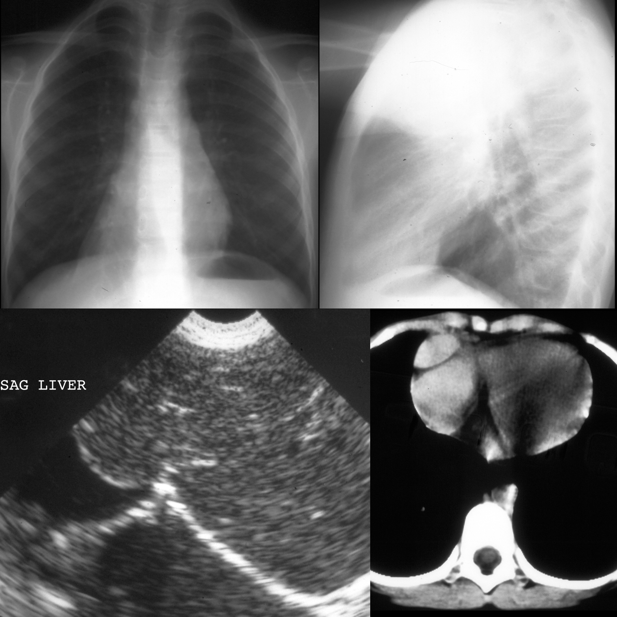 Morgagni Hernia | Pediatric Radiology Reference Article | Pediatric ...