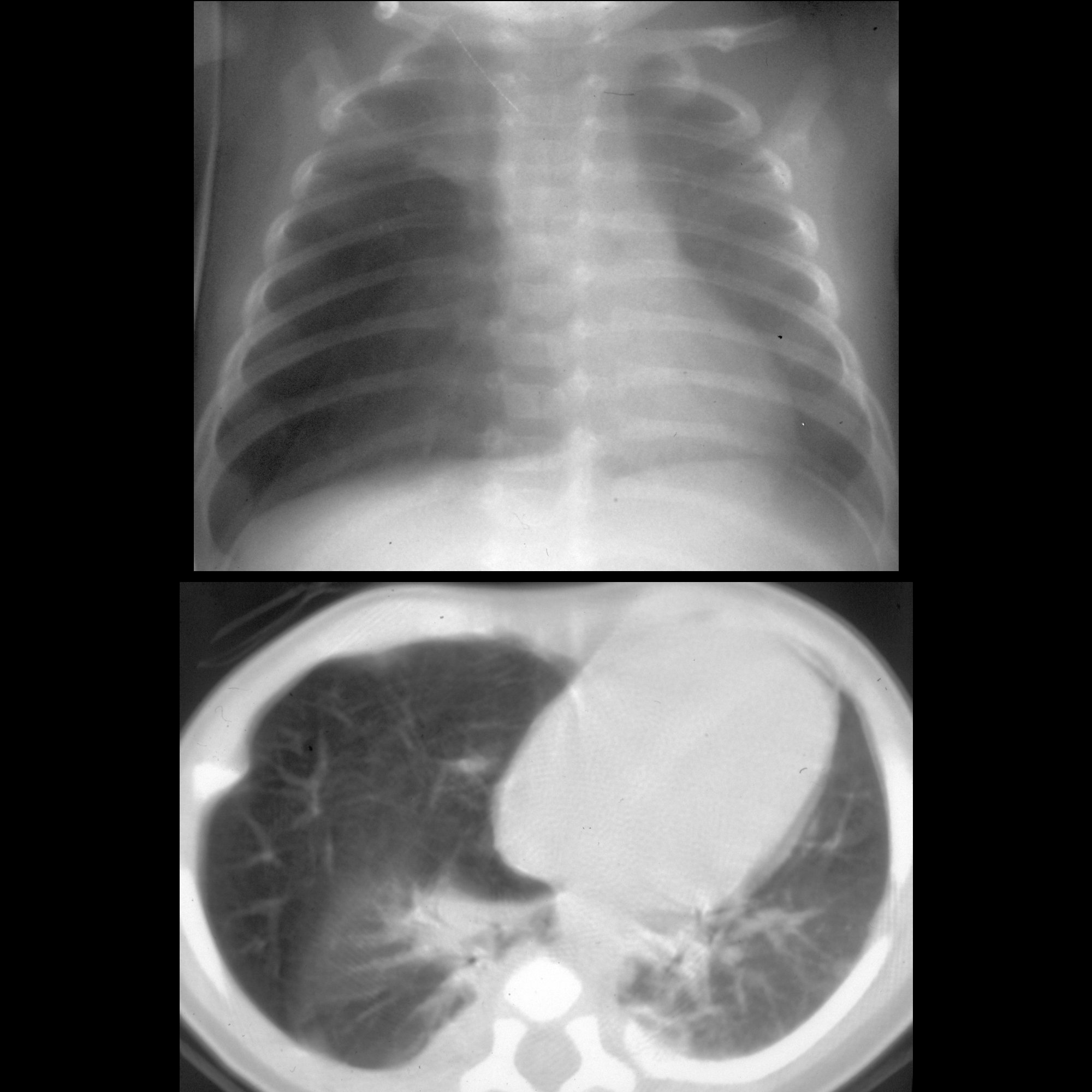 Congenital Lobar Emphysema | Pediatric Radiology Reference Article ...