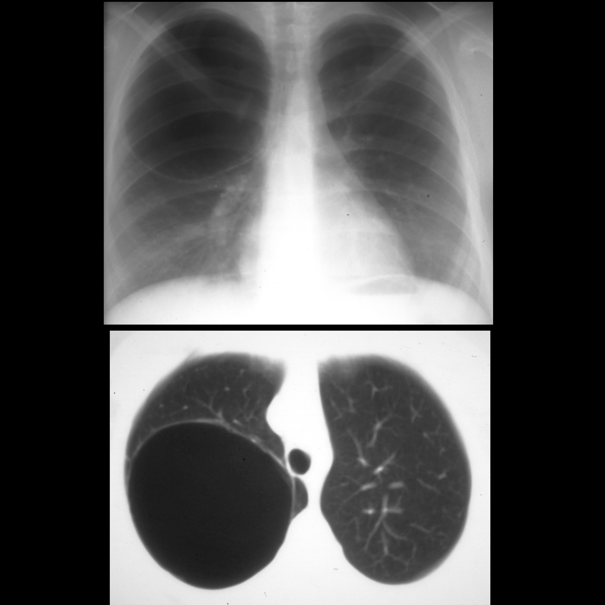 Congenital Pulmonary Airway Malformation | Pediatric Radiology ...