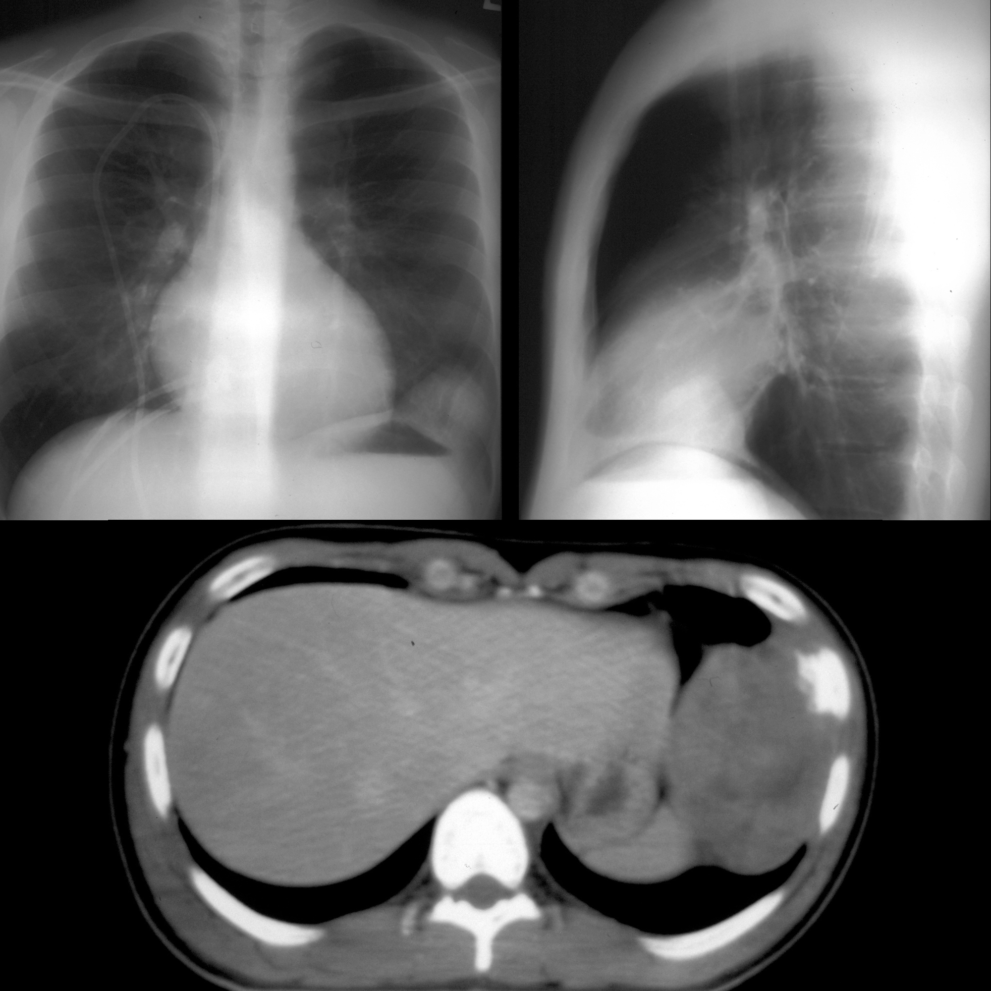 Teenager with fever and left pleuritic chest pain | Pediatric Radiology ...