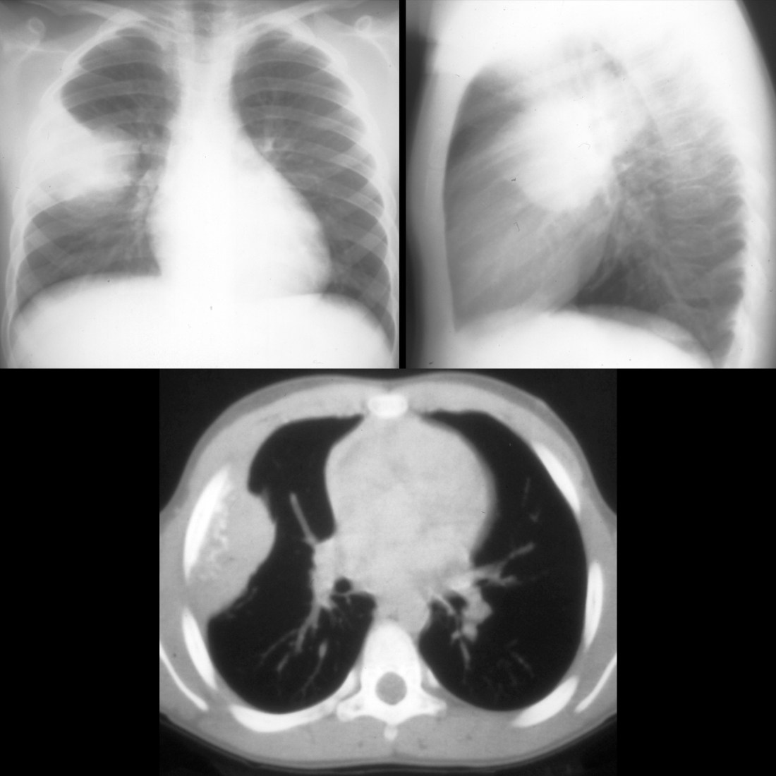 School ager with right scapular and right chest pain | Pediatric ...