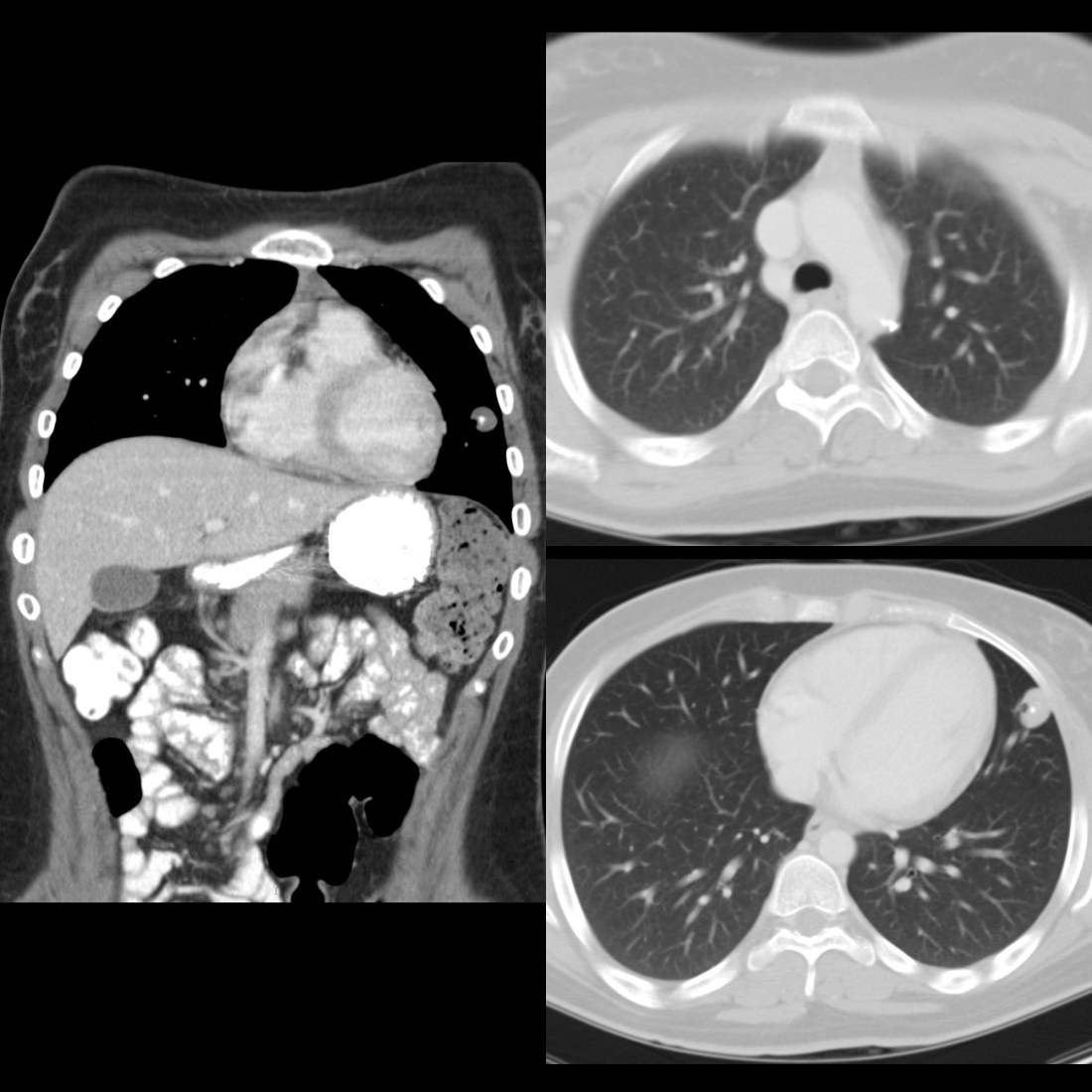 Pediatric Histoplasmosis | Pediatric Radiology Reference Article ...