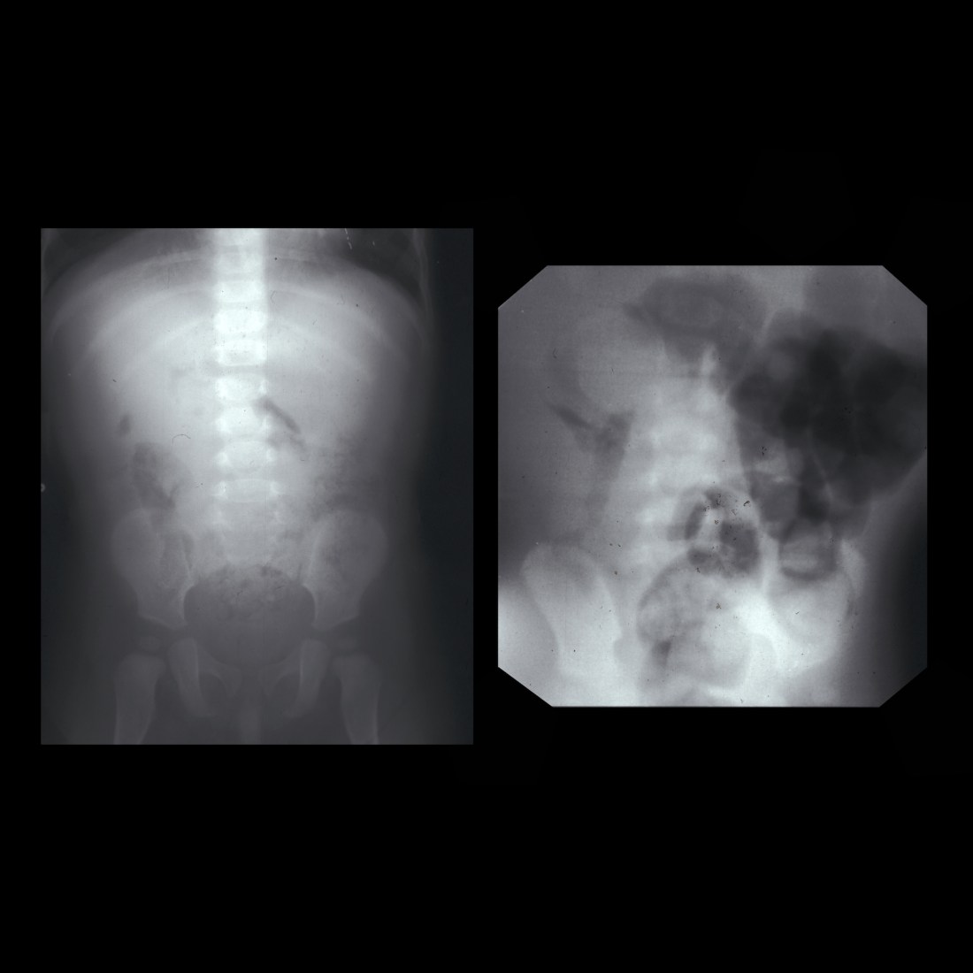 Ileocolic Intussusception | Pediatric Radiology Reference Article ...
