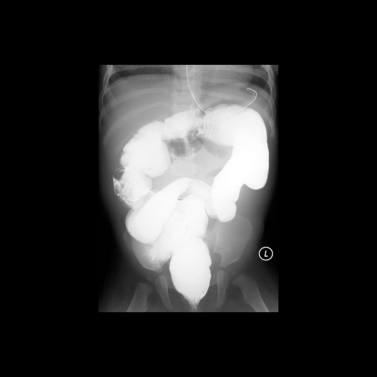 Ileocolic Intussusception | Pediatric Radiology Reference Article ...