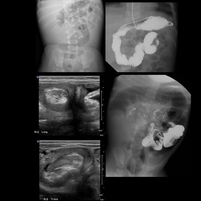 Ileocolic Intussusception | Pediatric Radiology Reference Article ...