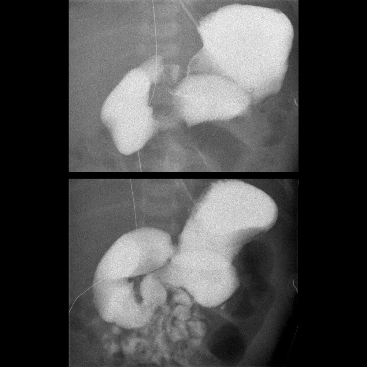 Newborn with vomiting who had a triple bubble sign on prenatal US ...