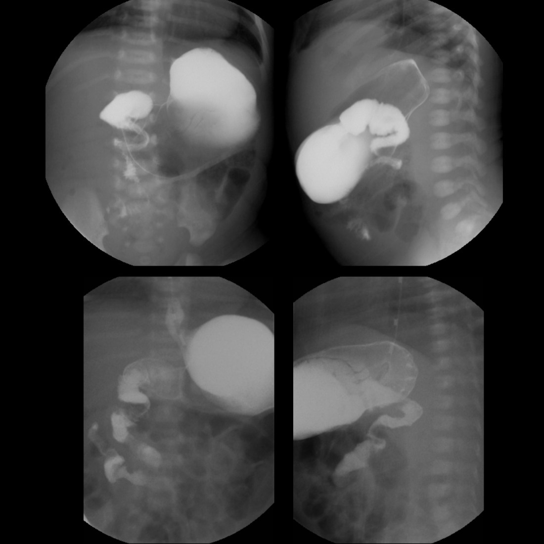 Malrotation With Midgut Volvulus | Pediatric Radiology Reference ...