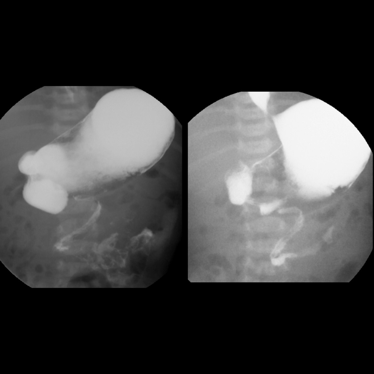 Newborn with bilious vomiting | Pediatric Radiology Case | Pediatric ...