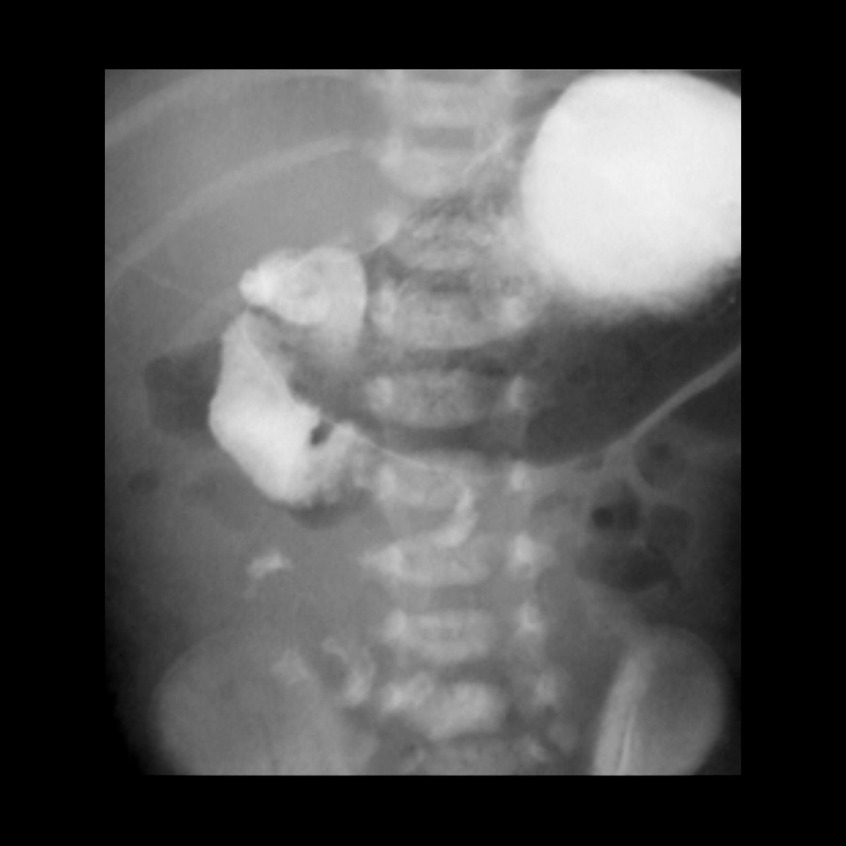 Newborn with bilious vomiting | Pediatric Radiology Case | Pediatric ...