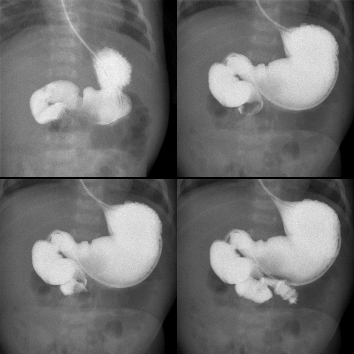 Newborn with 3 days of bilious vomiting | Pediatric Radiology Case ...