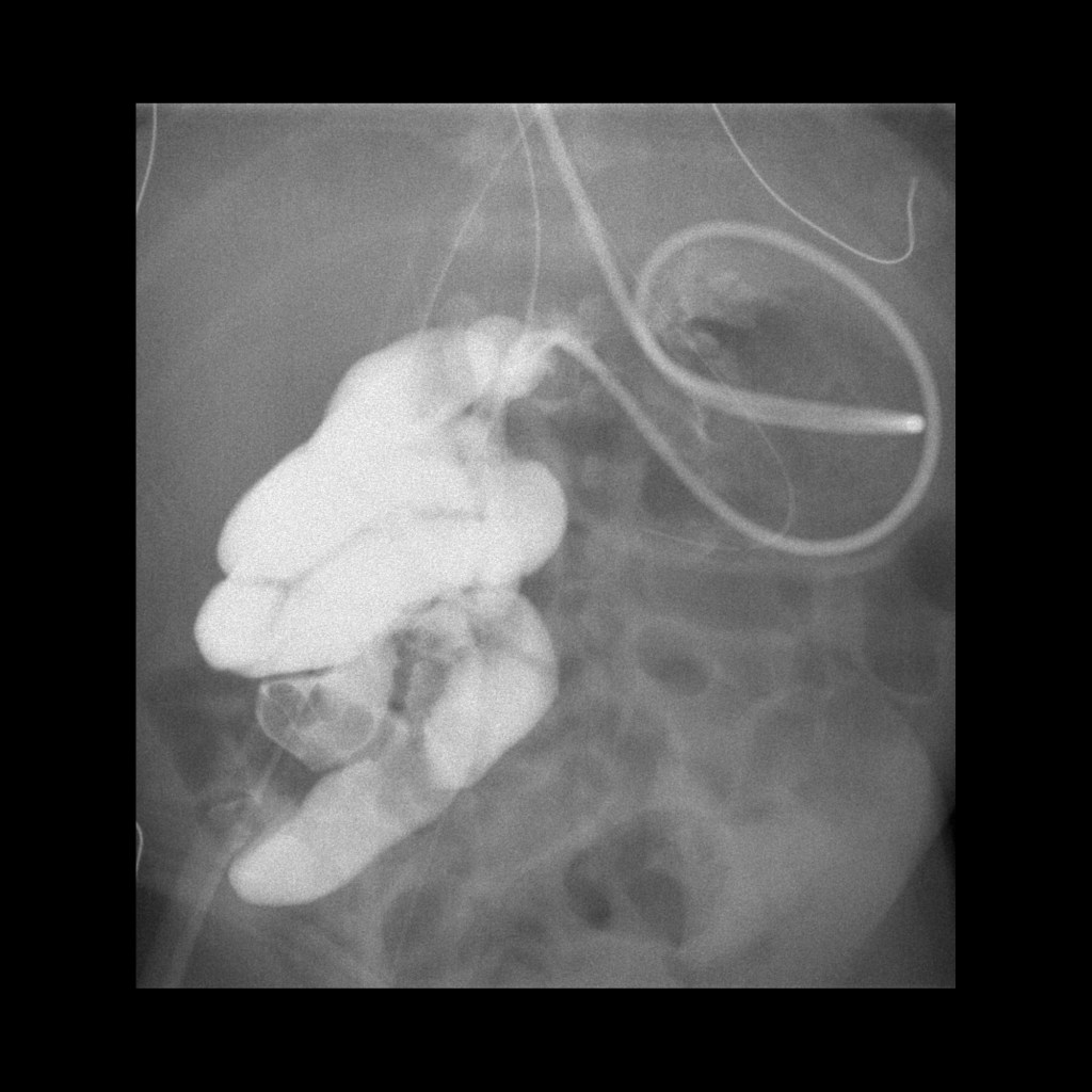 Malrotation Without Midgut Volvulus | Pediatric Radiology Reference ...