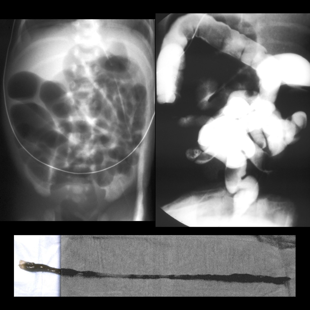 Meconium Plug Syndrome | Pediatric Radiology Reference Article ...