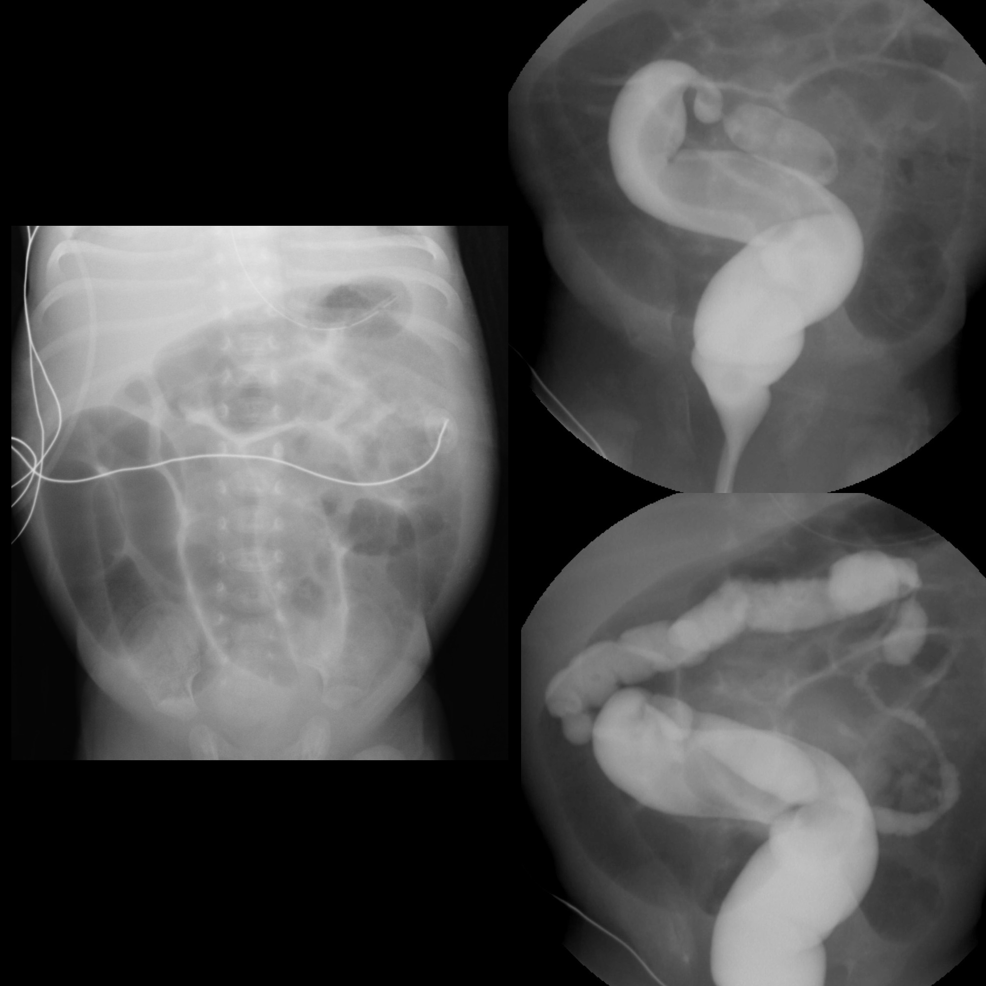Necrotizing Enterocolitis | Pediatric Radiology Reference Article ...