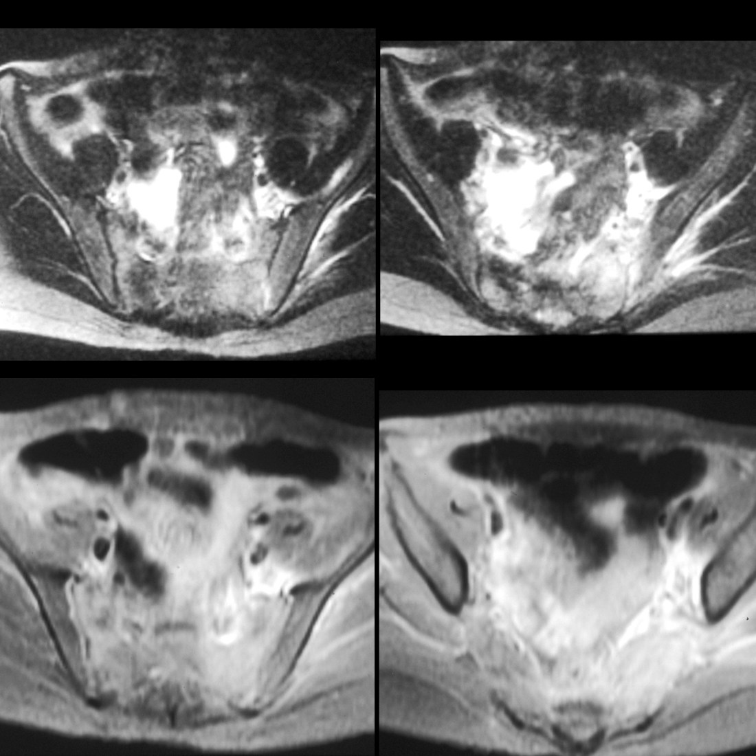 Pediatric Acute Osteomyelitis (Greater Than 18 Months) | Pediatric ...
