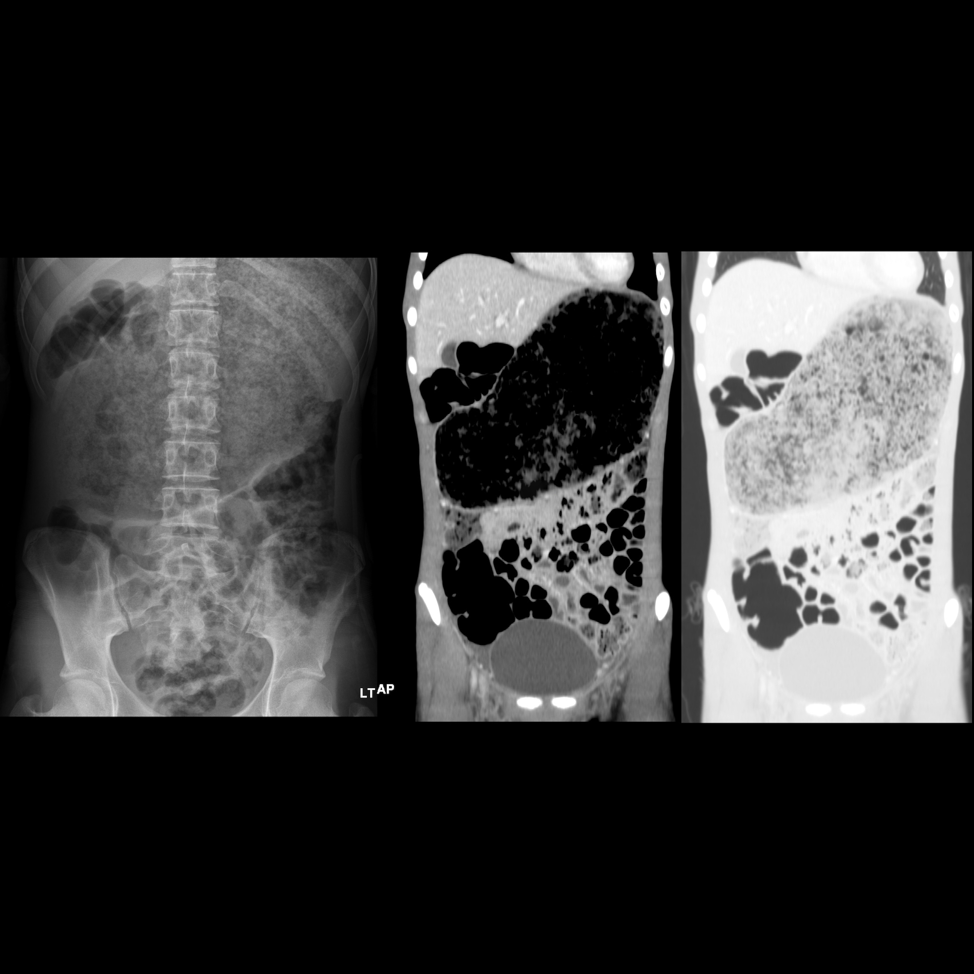 Phytobezoar01MDVegetableProteinXanthumDietAXRCT14yo | Pediatric ...