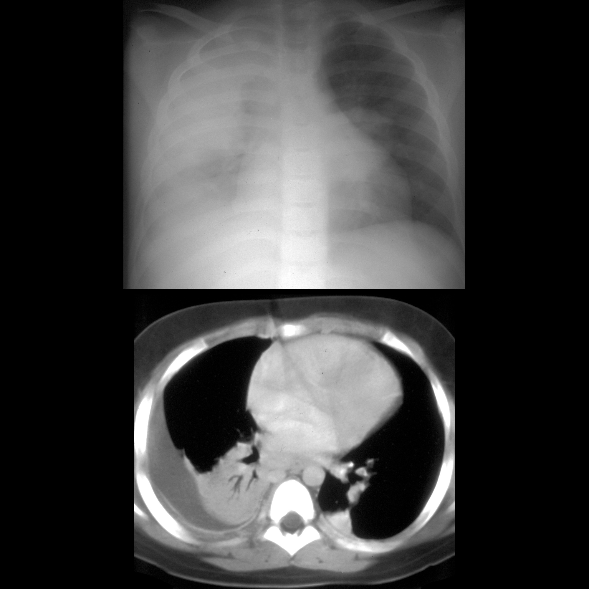 School ager with fever and cough | Pediatric Radiology Case | Pediatric ...