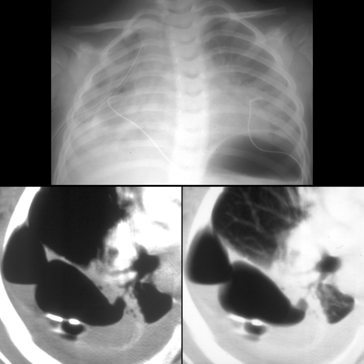 Toddler with respiratory distress | Pediatric Radiology Case ...