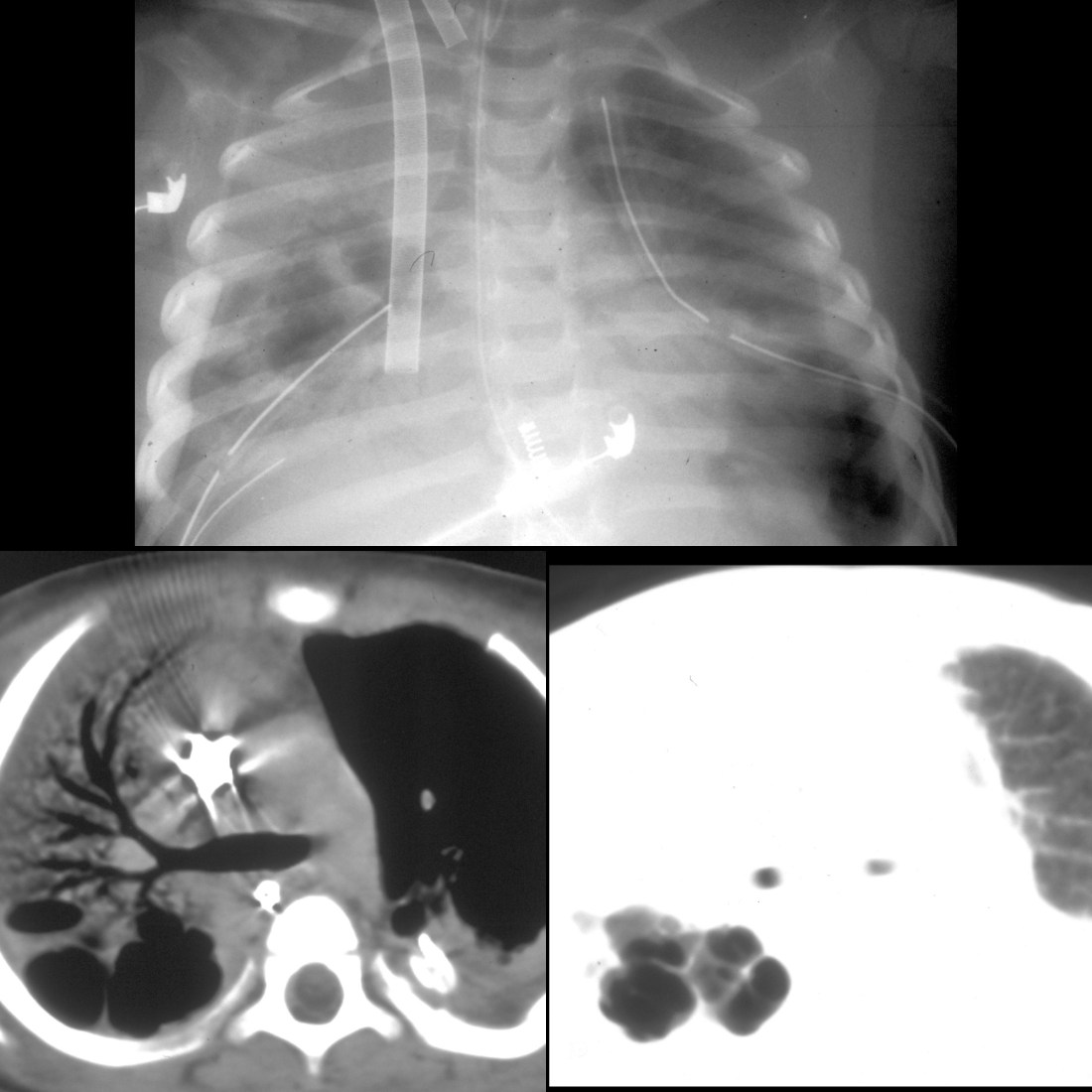 Pediatric Extracorporeal Membrane Oxygenation | Pediatric Radiology ...