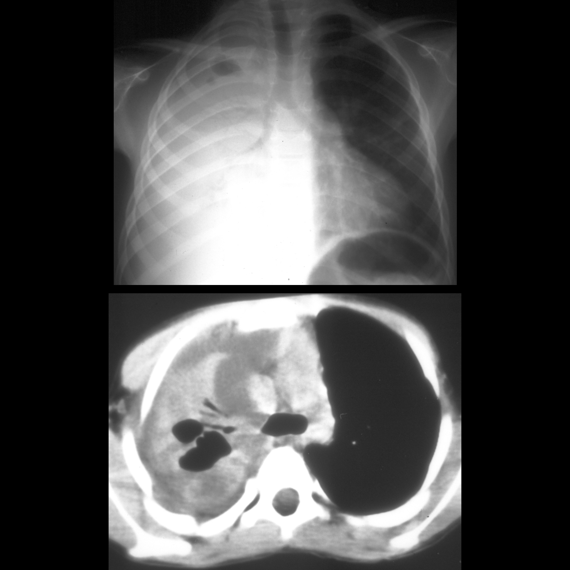 School ager with cough and fever and chest pain | Pediatric Radiology ...