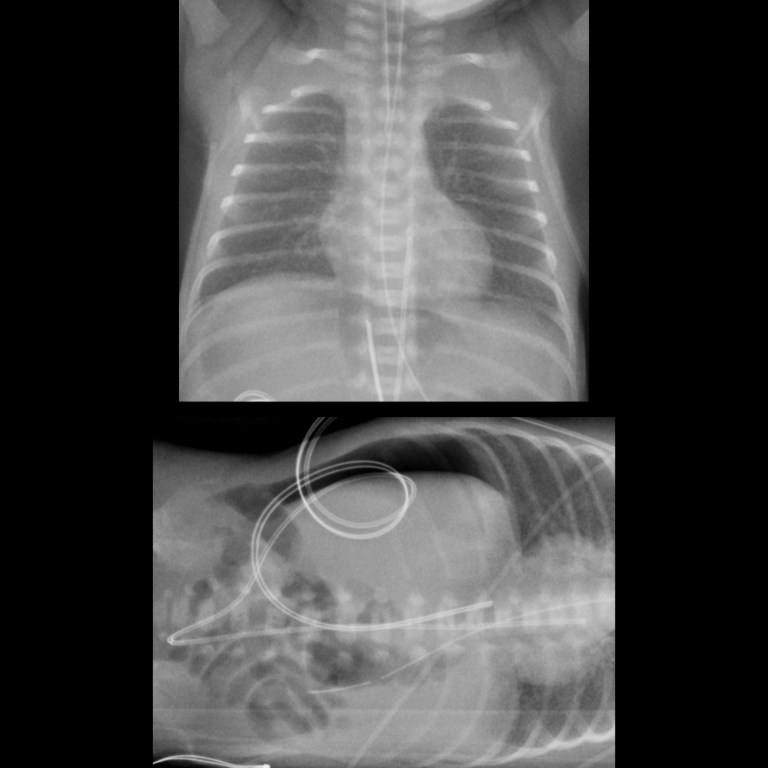Pediatric Pneumoperitoneum | Pediatric Radiology Reference Article ...