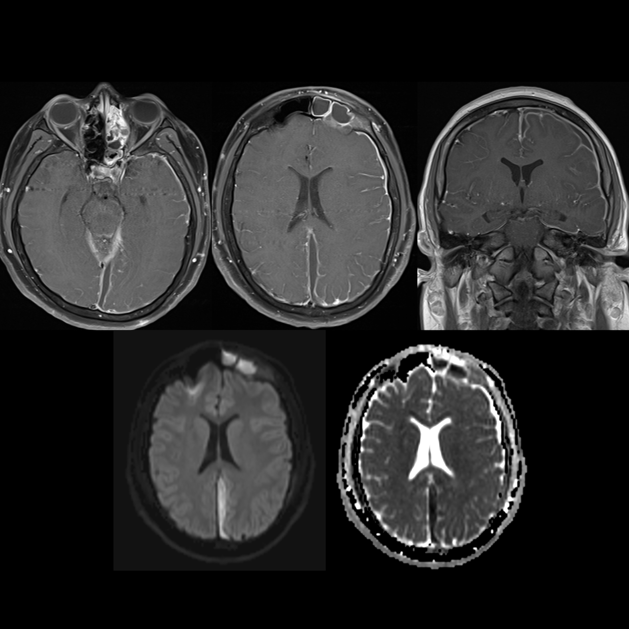 SubduralEmpyema01MDPansinusitisMeningitisNasalCongestion1WeekHeadacheFe ...