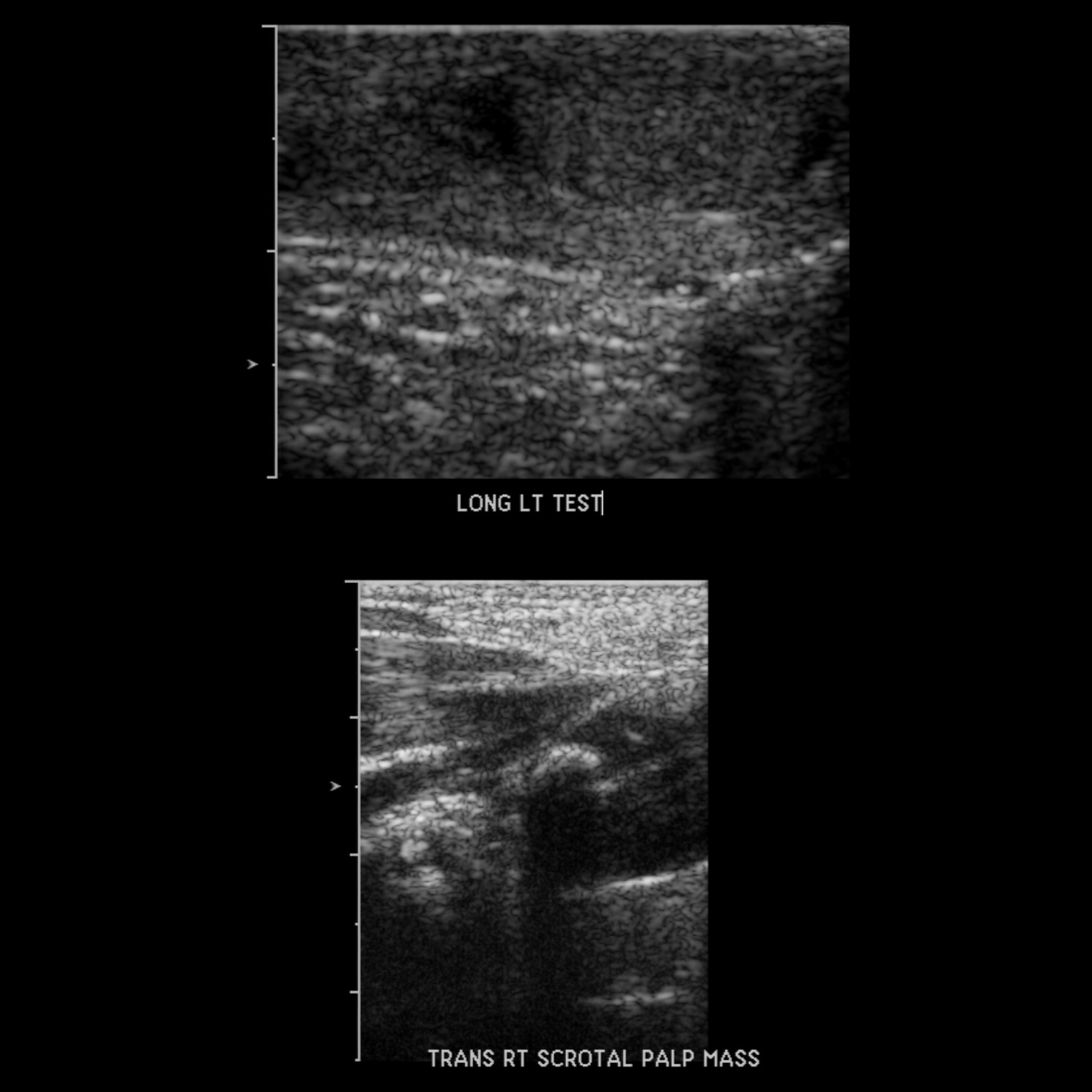 Pediatric Testicle Torsion | Pediatric Radiology Reference Article ...