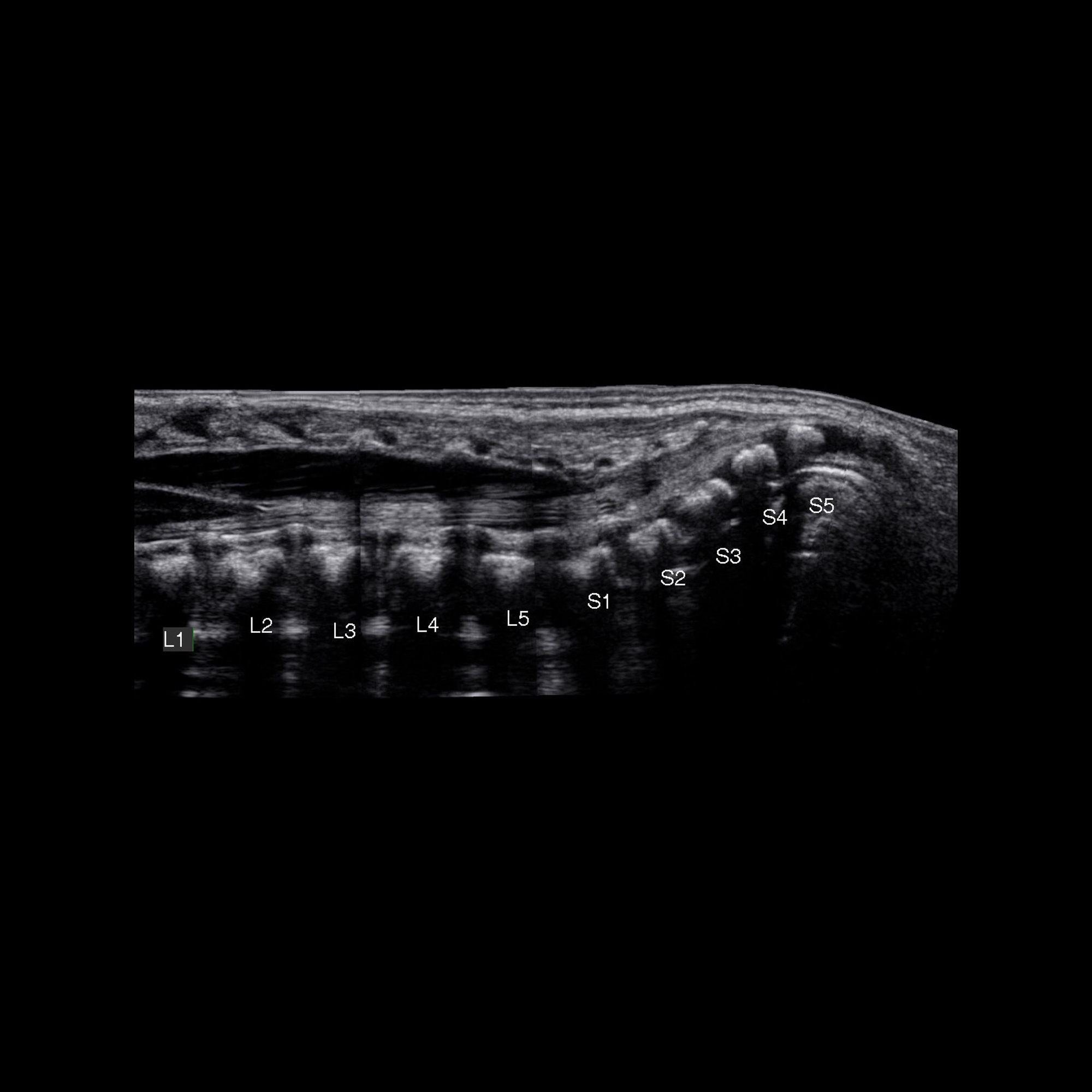 Newborn with a sacral dimple | Pediatric Radiology Case | Pediatric ...