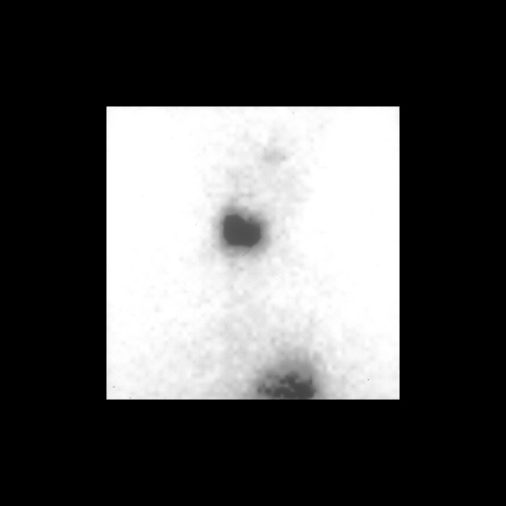 Ectopic Thyroid | Pediatric Radiology Reference Article | Pediatric ...