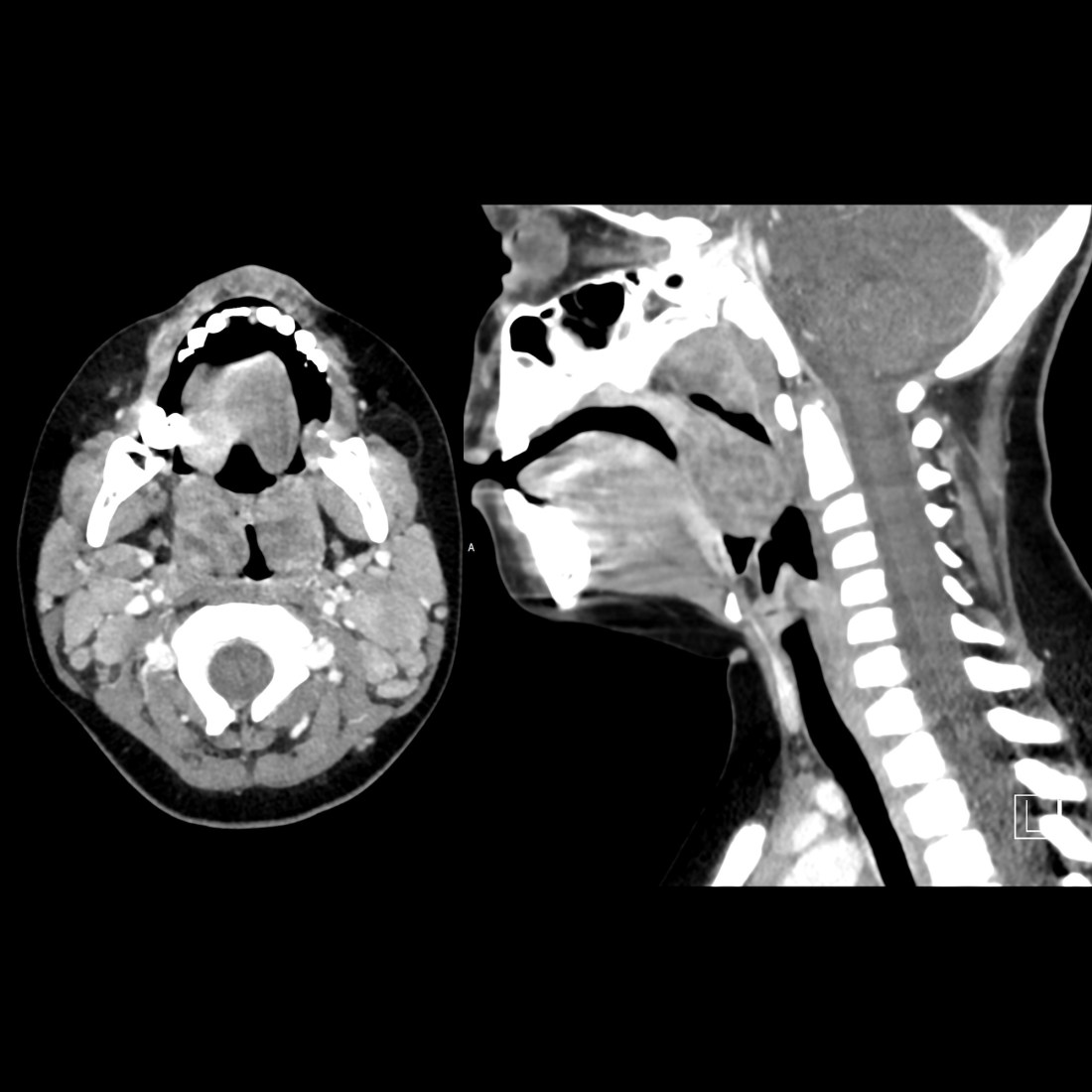Pediatric Palatine Tonsillar Hypertrophy | Pediatric Radiology ...