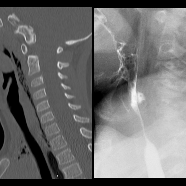 Preschooler who hit their throat on the rim of a plastic chair and now ...