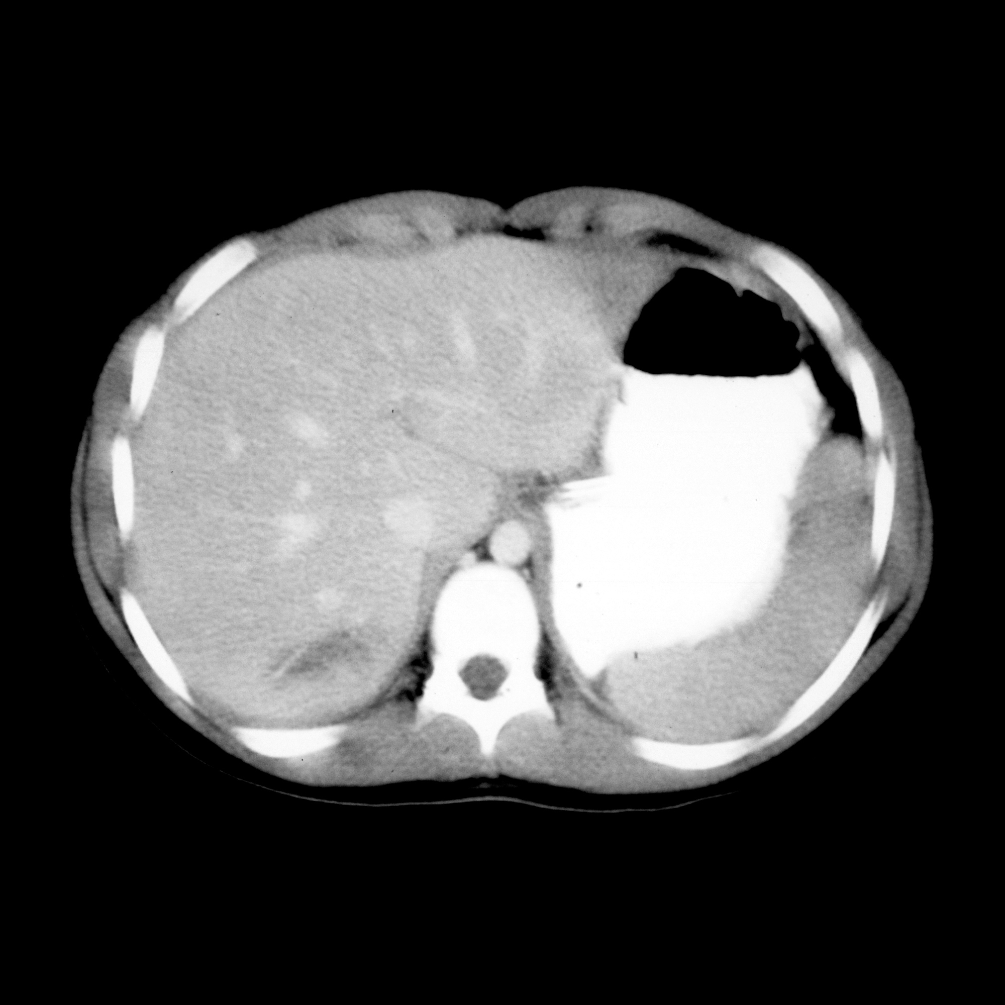 Pediatric Liver Trauma | Pediatric Radiology Reference Article ...