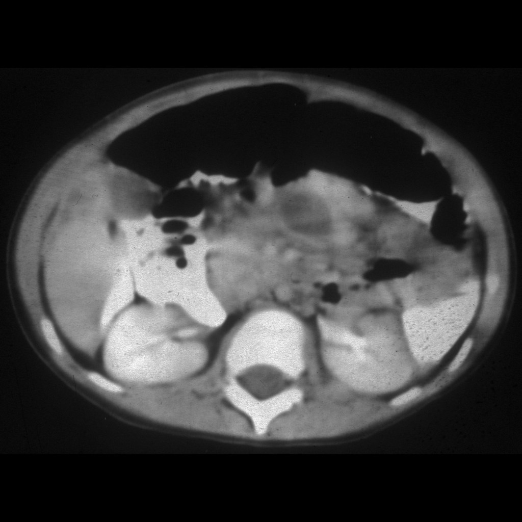 Pediatric Pancreatic Trauma | Pediatric Radiology Reference Article ...