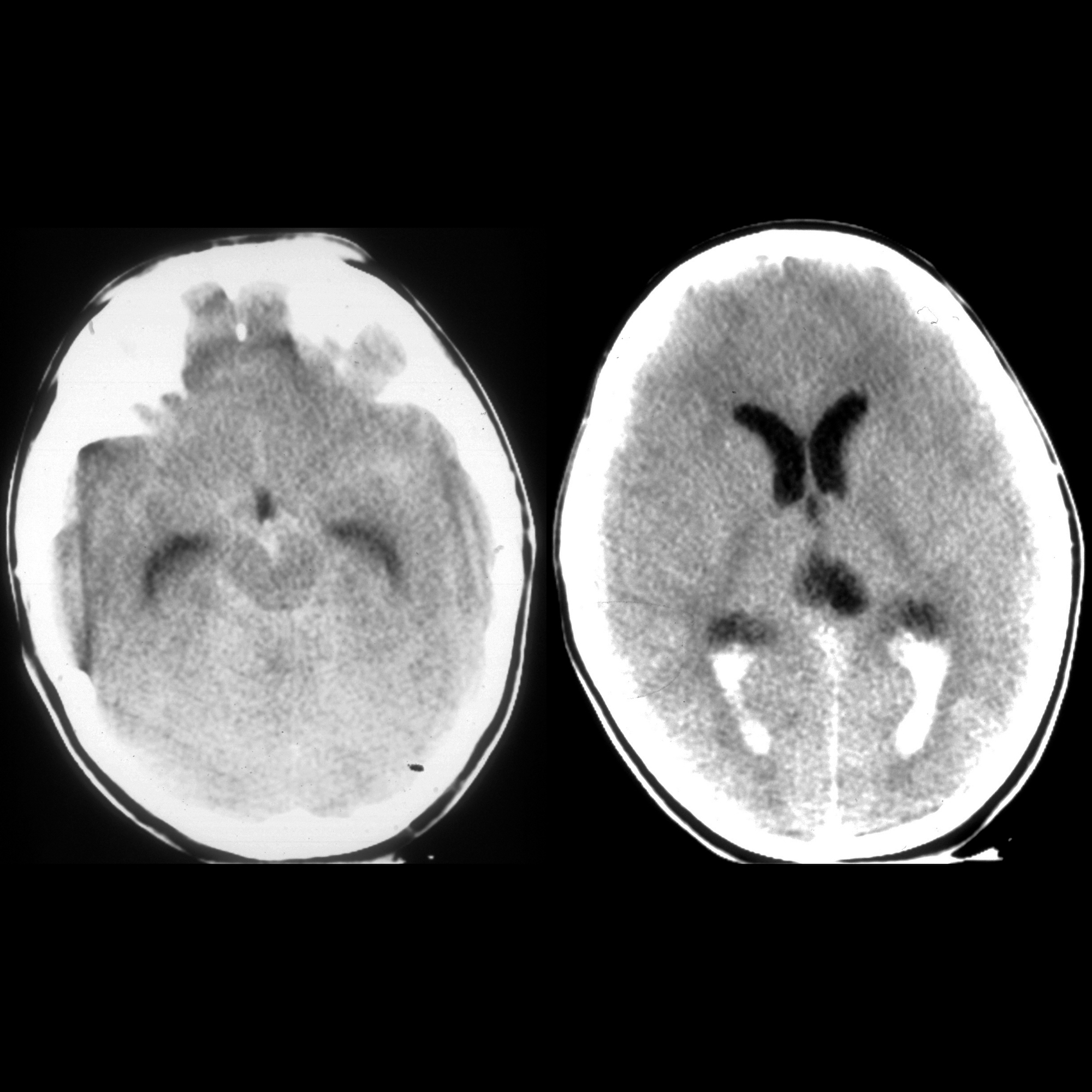Pediatric Diffuse Cerebral Edema | Pediatric Radiology Reference ...