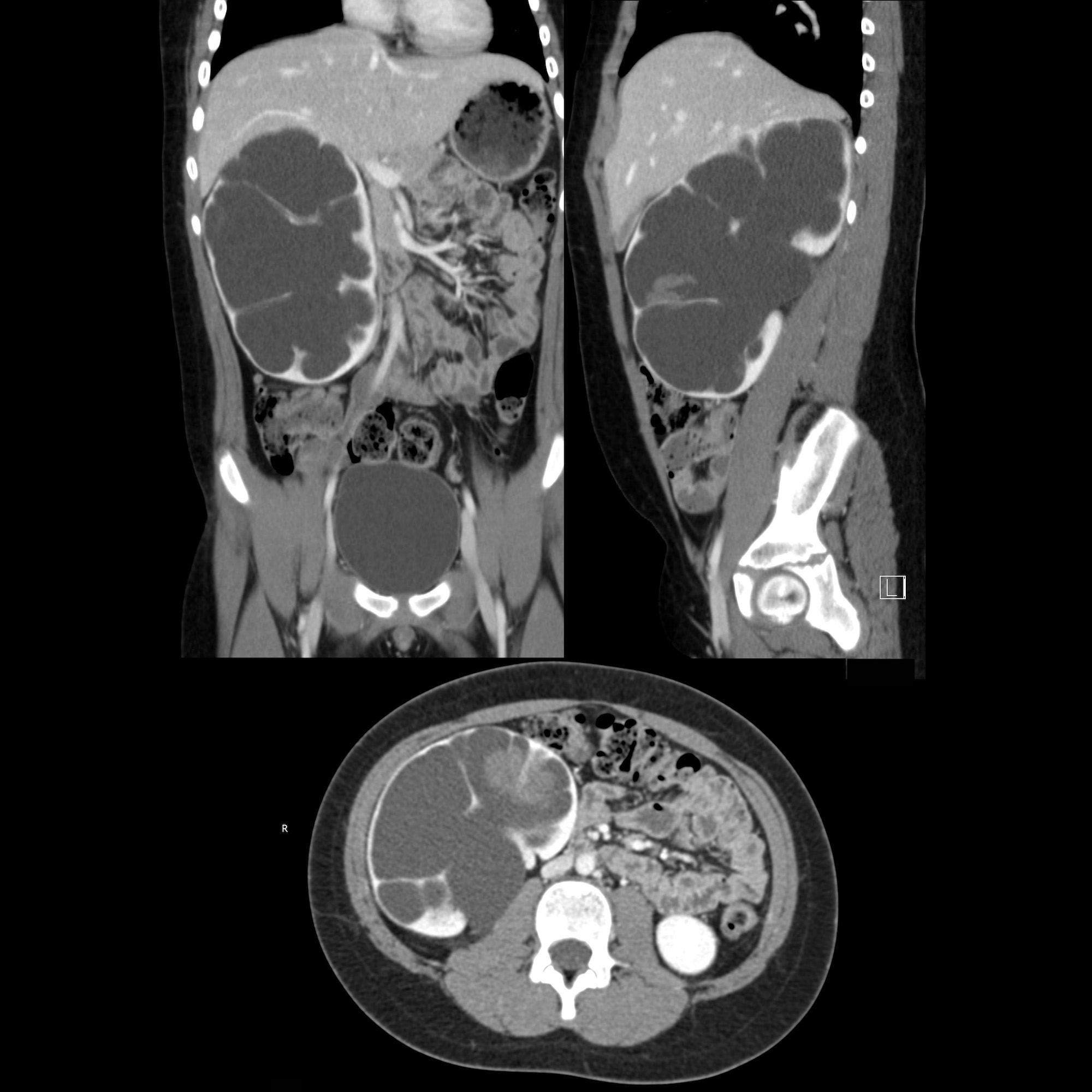 School ager with right flank pain and hematuria after falling off a ...