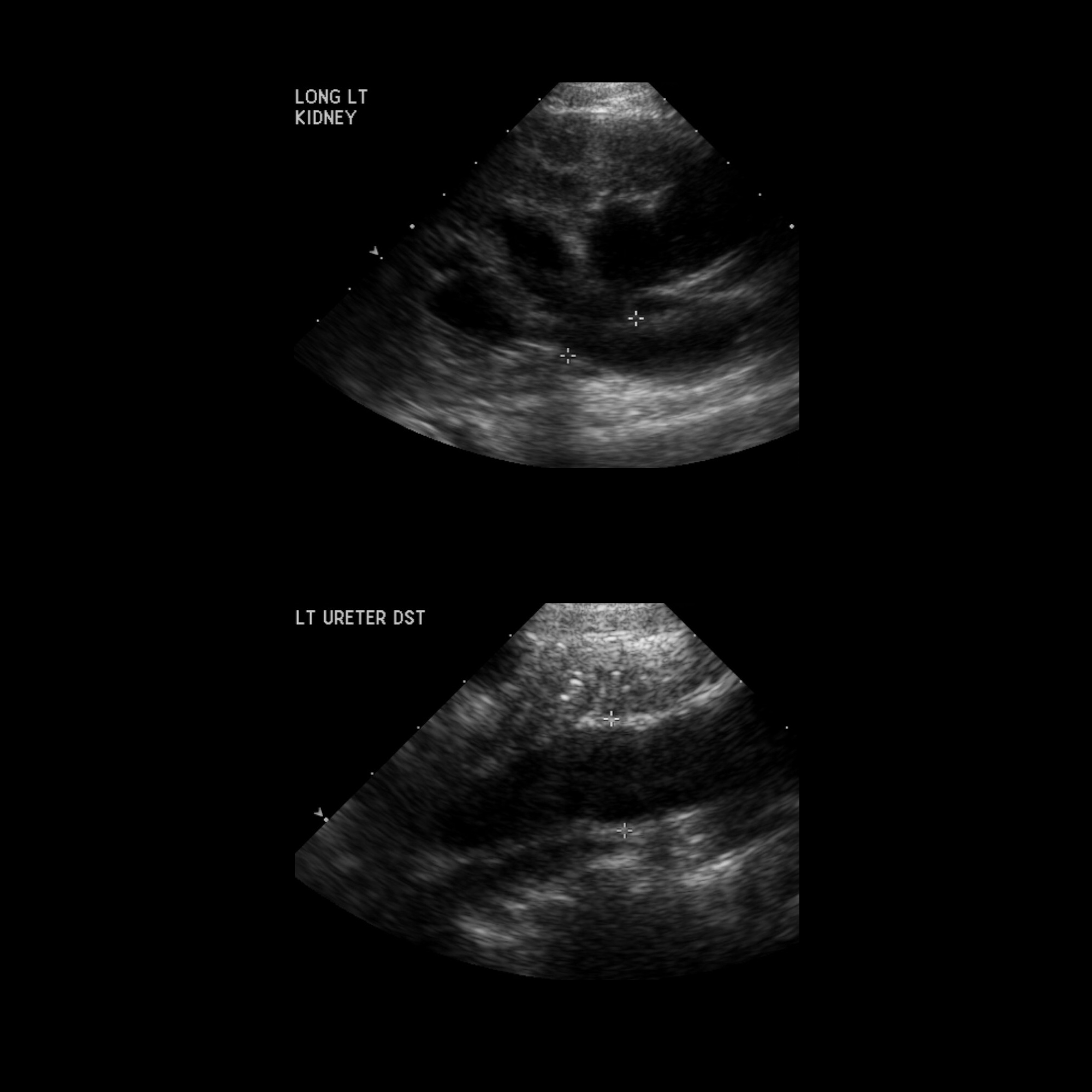 Congenital Megaureter | Pediatric Radiology Reference Article ...