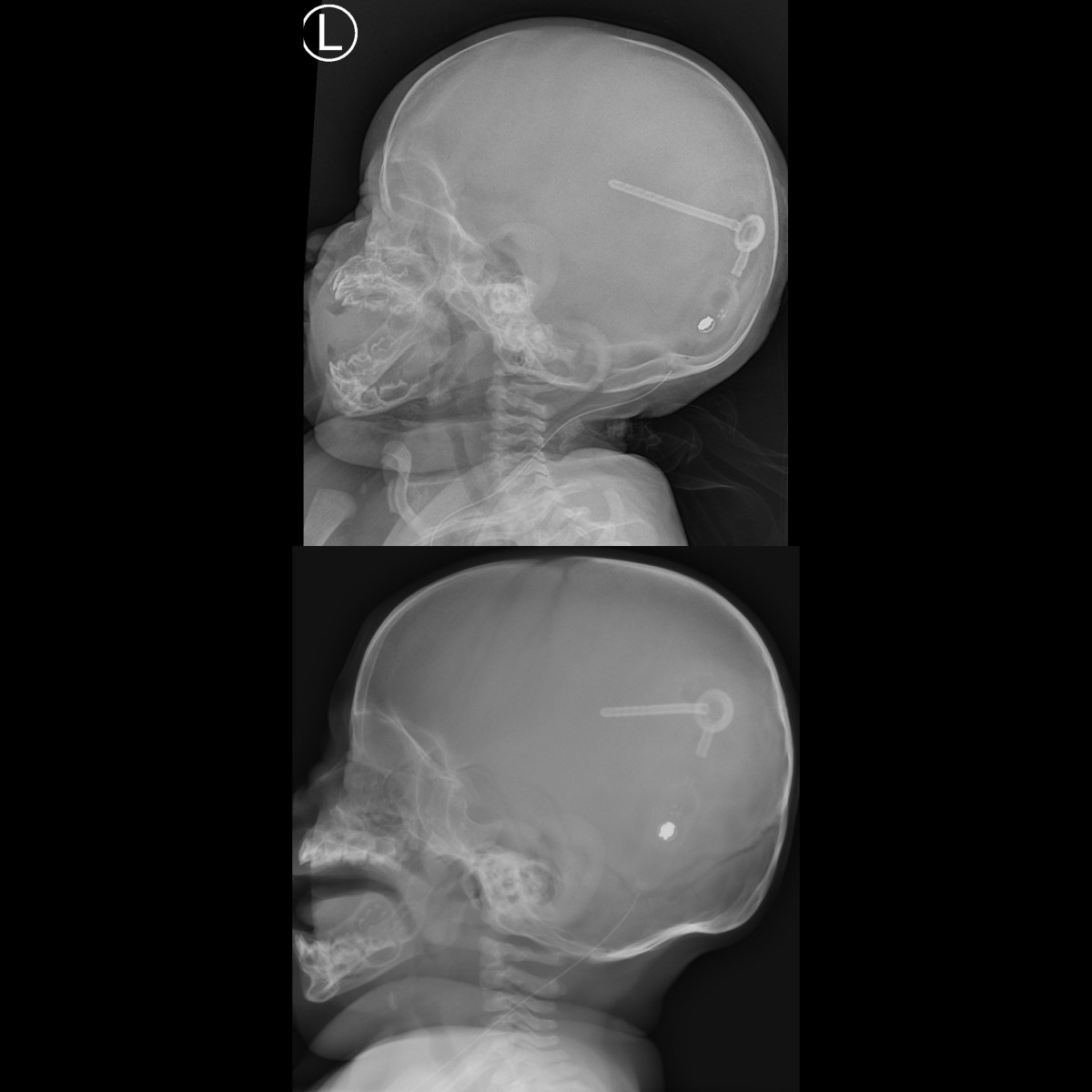 Infant with a VP shunt and decreased activity for the last few days ...
