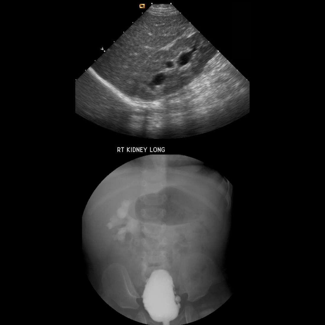 Pediatric Neurogenic Bladder | Pediatric Radiology Reference Article ...