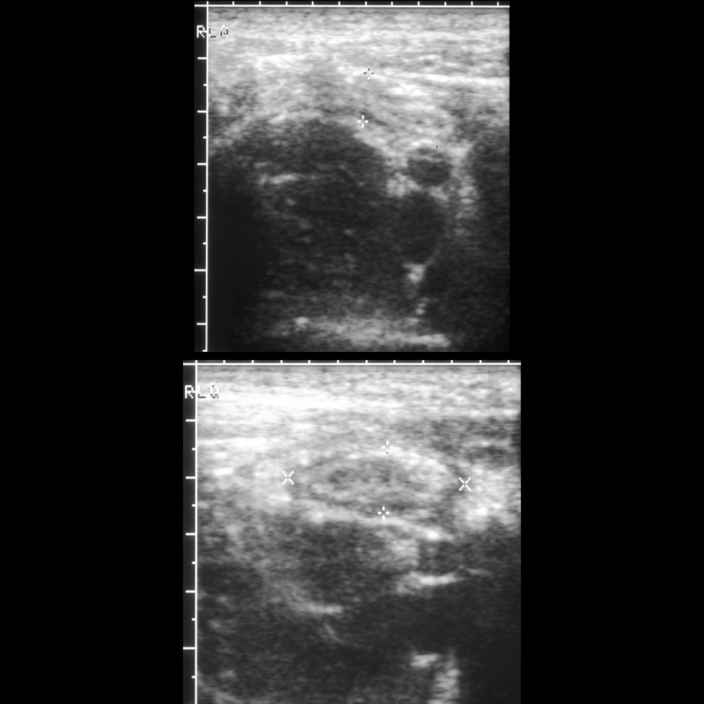 Pediatric Appendicitis | Pediatric Radiology Reference Article ...
