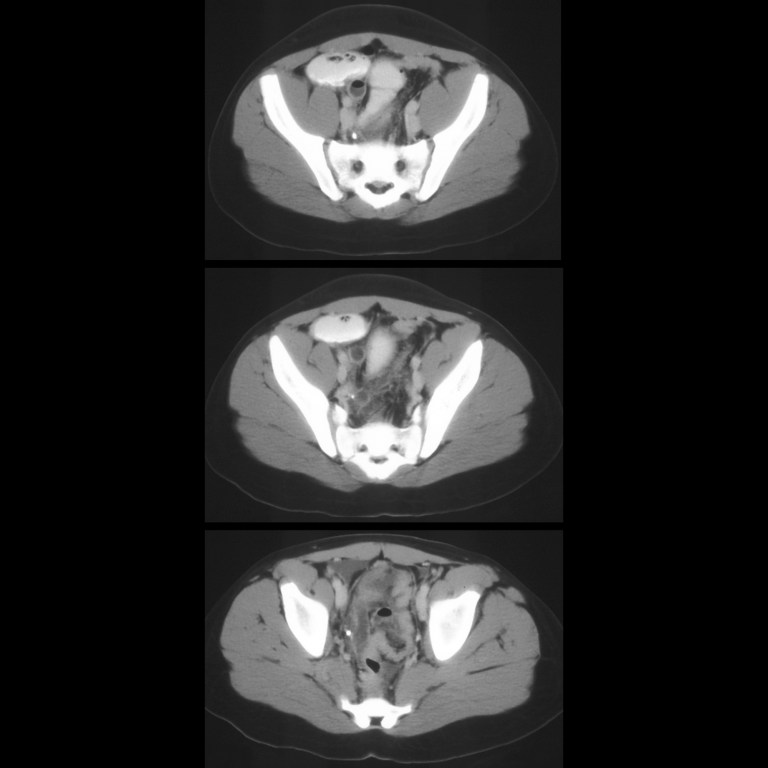 Pediatric Appendicitis | Pediatric Radiology Reference Article ...