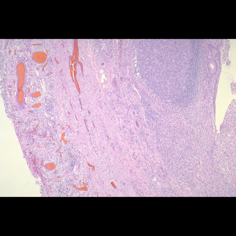 Pediatric Appendicitis | Pediatric Radiology Reference Article ...