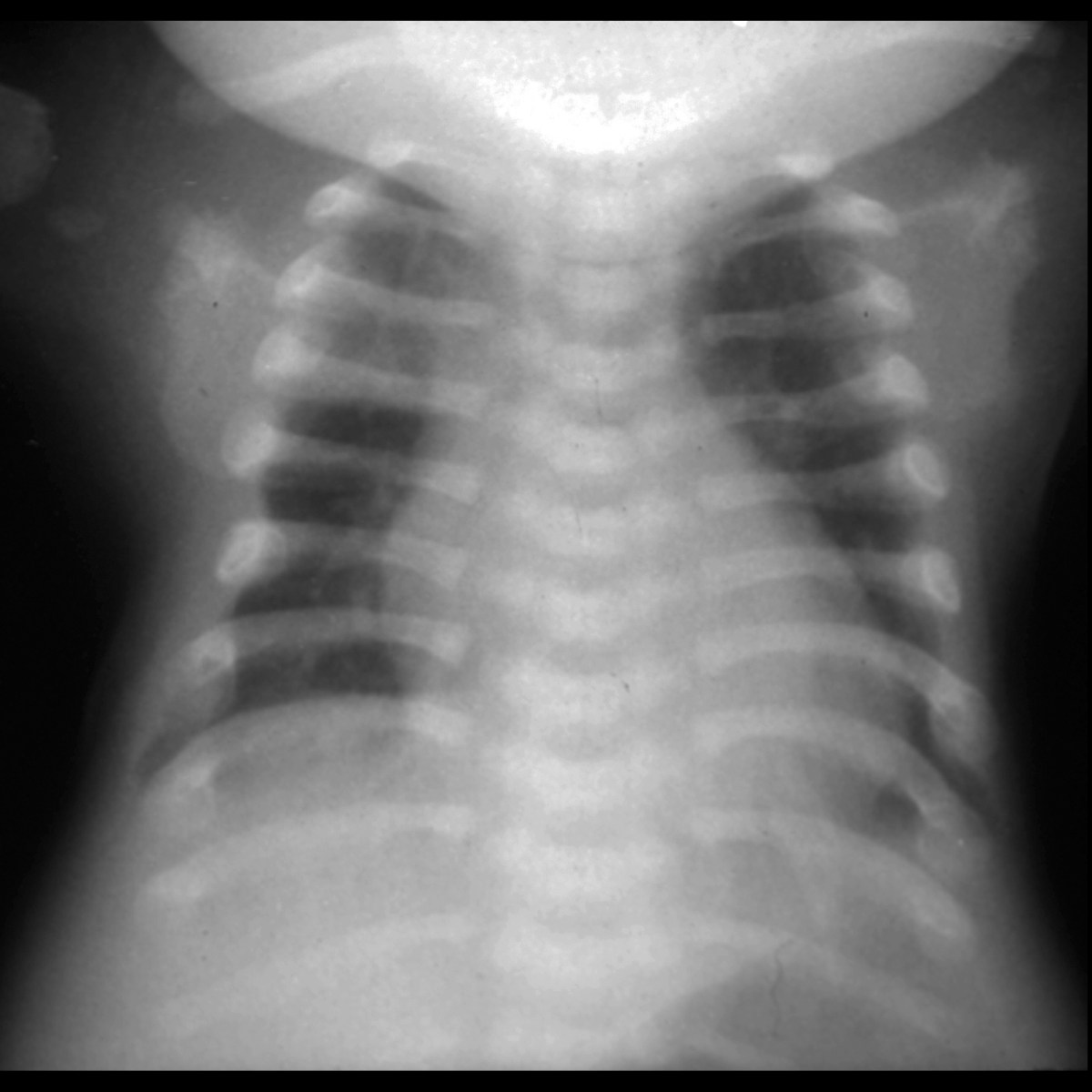 Newborn with respiratory distress | Pediatric Radiology Case ...