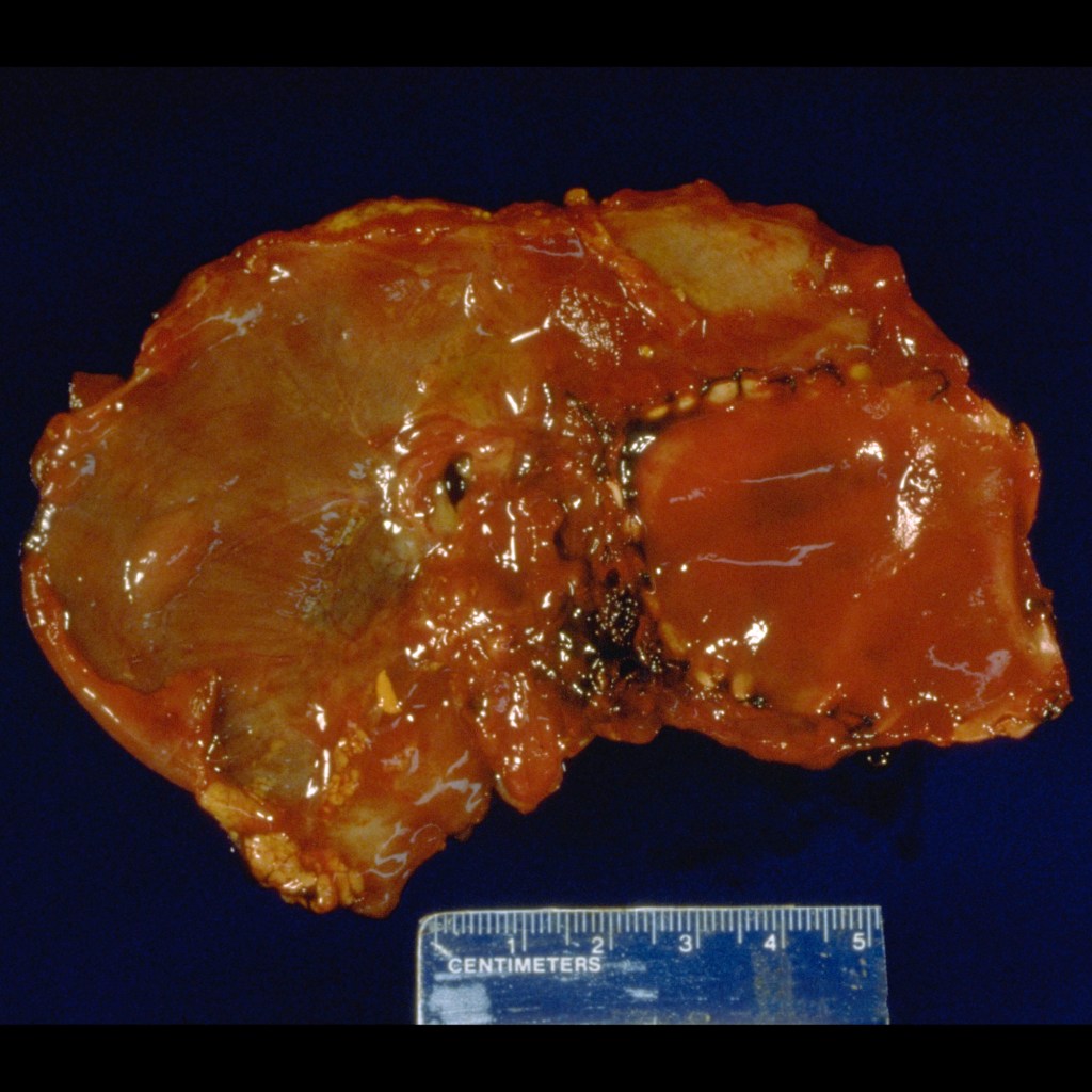 Newborn with left diaphragmatic hernia status post repair | Pediatric ...