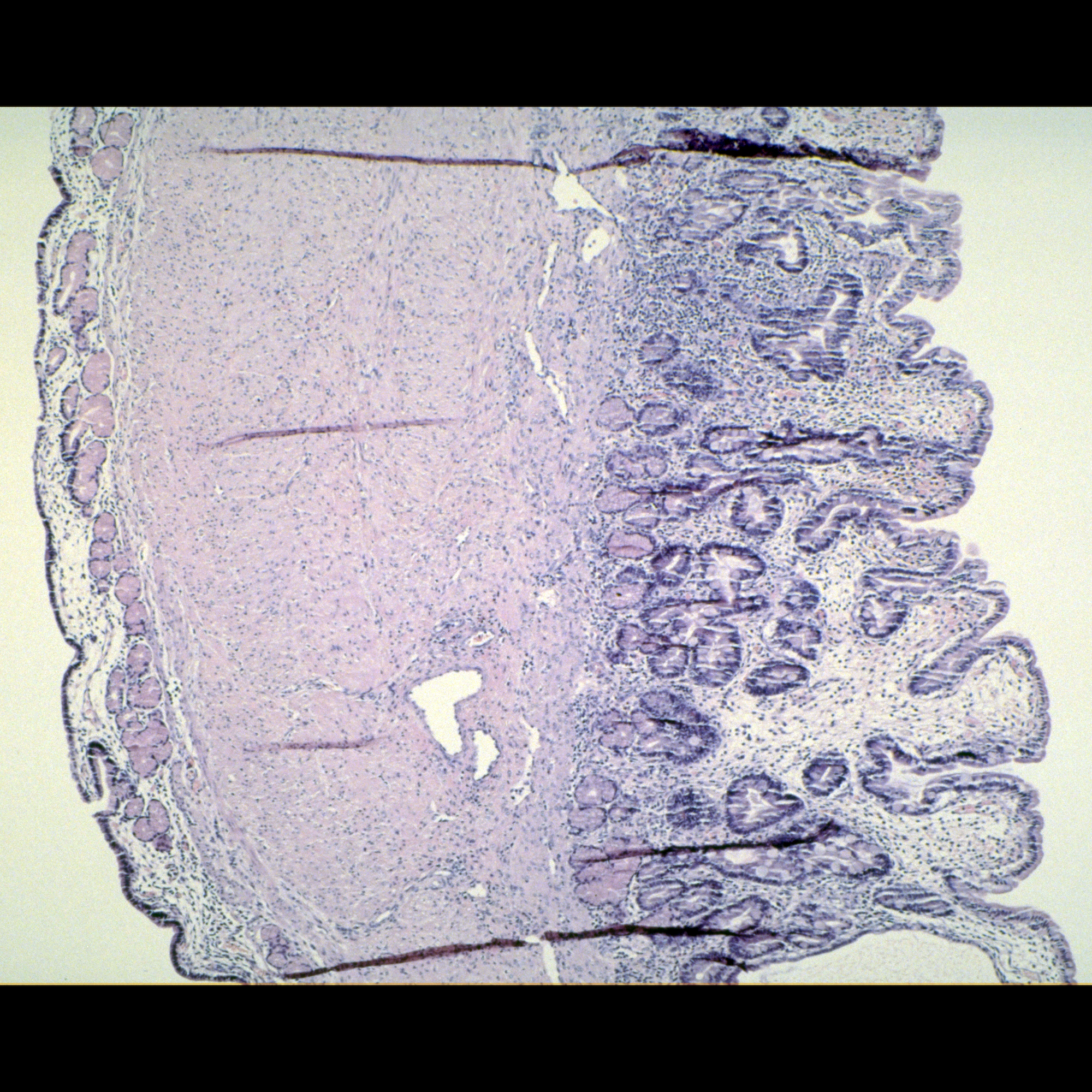 DuodenalDuplication01CAP07MicroPath | Pediatric Radiology Case ...