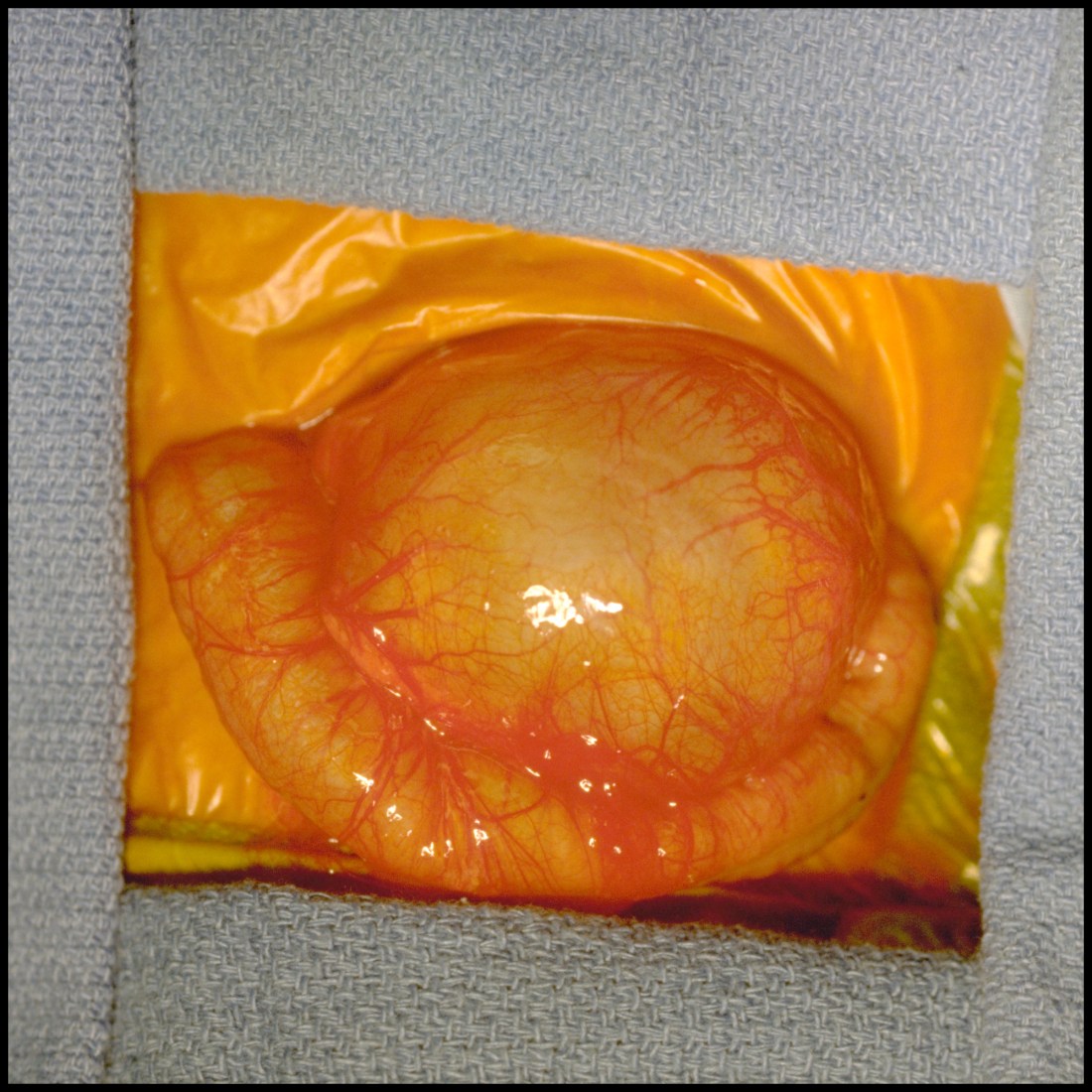 Duodenal Duplication | Pediatric Radiology Reference Article ...