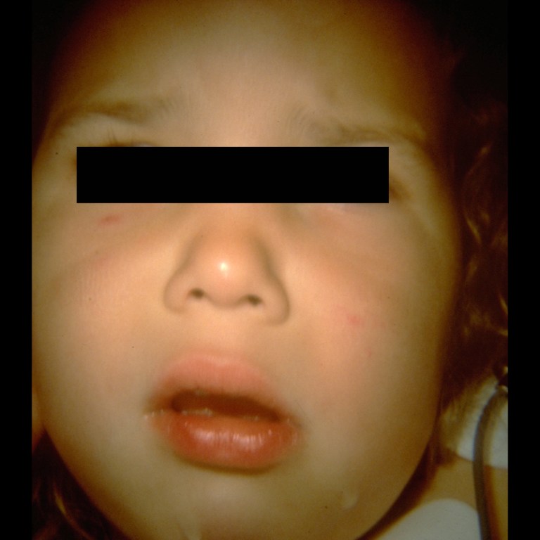 Epiglottitis | Pediatric Radiology Reference Article | Pediatric ...