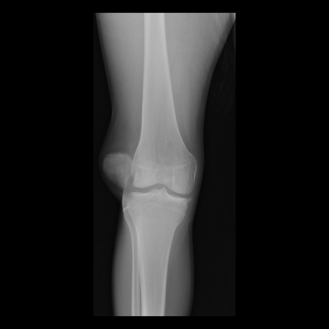 Reverse Segond Fracture | Pediatric Radiology Reference Article ...