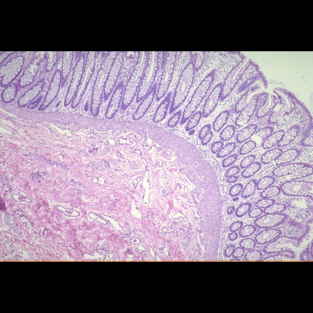 Hirschsprung disease radiology discussion including radiology cases.