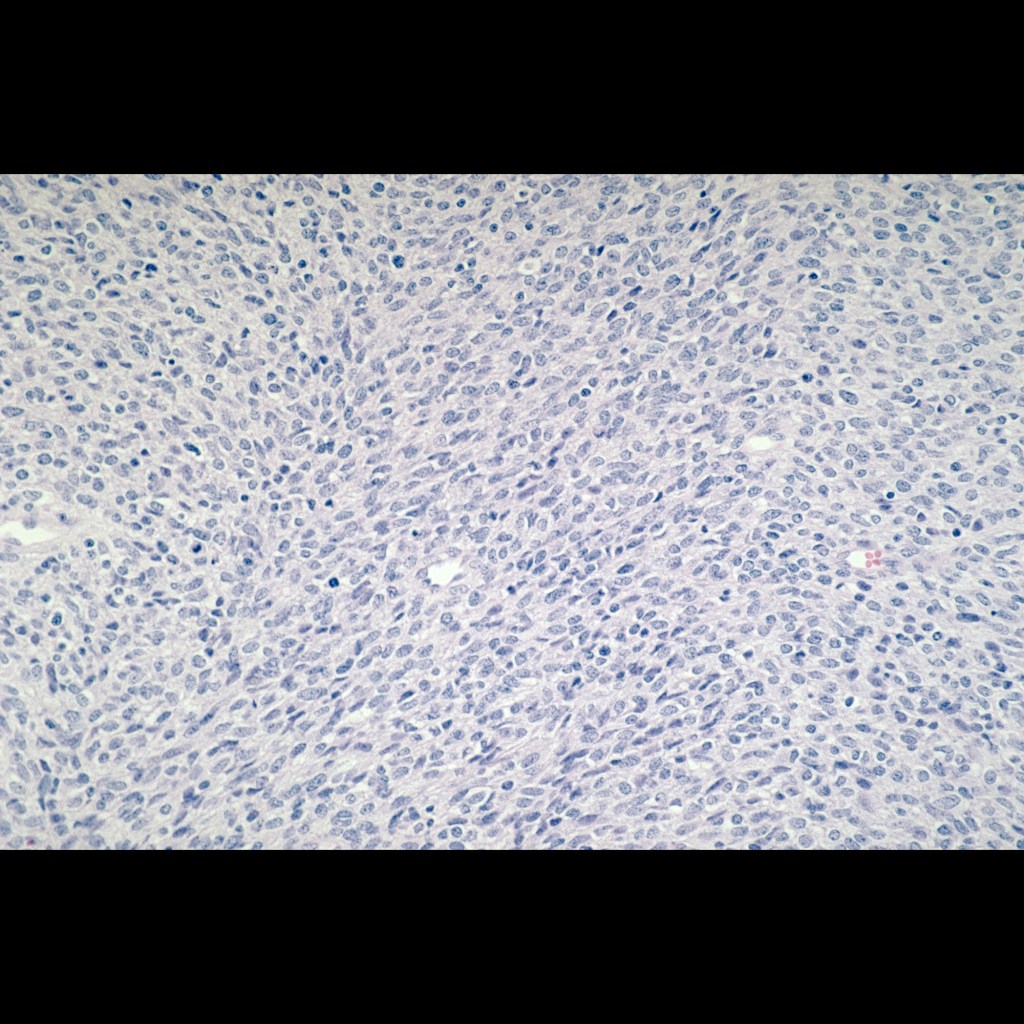 Infantile Fibrosarcoma | Pediatric Radiology Reference Article ...